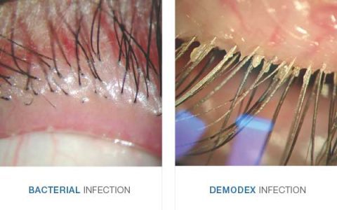 Dry Eye - Vista Eye Care