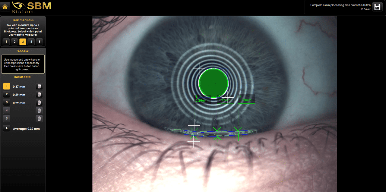 Dry Eye - Vista Eye Care